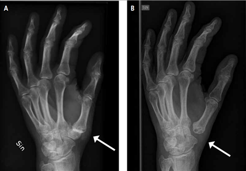 Peukalon tyven ja sormien nivelrikko