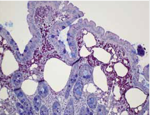 Whipplen tauti - harvinainen ja vakava systeemi-infektio