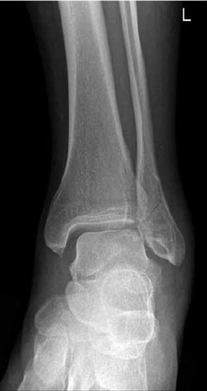 Milloin nilkkamurtuman voi hoitaa ilman leikkausta?