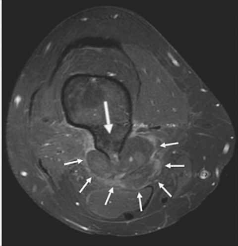 Nuoren naisen polvikipu ja syvä laskimotukos