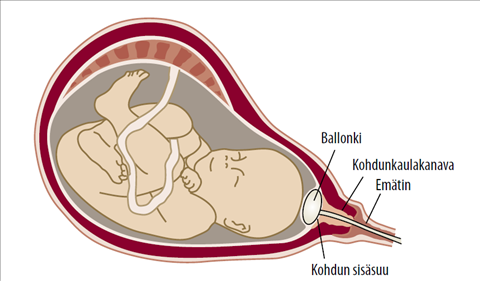 Synnytyksen käynnistäminen ballonkimenetelmällä