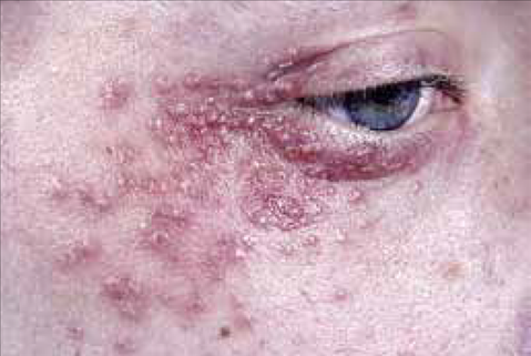 Uusia näkemyksiä ruusufinnin patogeneesistä ja hoidosta