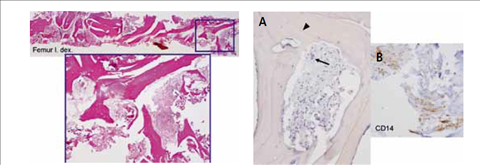 Aiemmin terveen naisen jano ja laaja-alaiset luustomuutokset