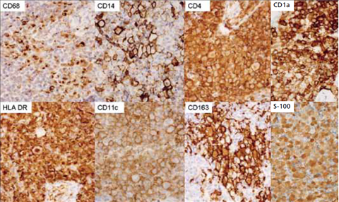 Aiemmin terveen naisen jano ja laaja-alaiset luustomuutokset