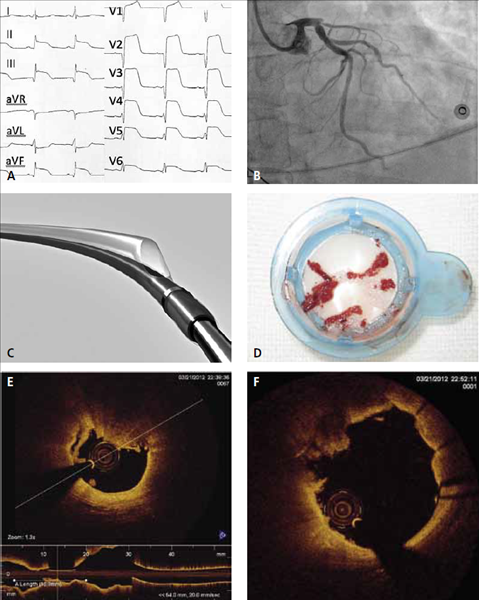 Akuutin ST-nousuinfarktin hoito pallolaajennuksella