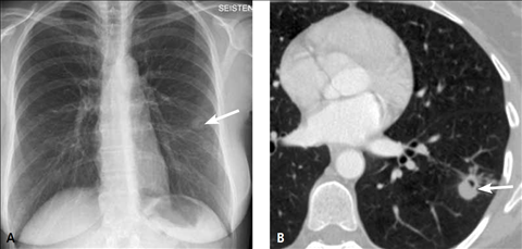 Tuberkuloosi tarttuu sairaalassa ja ruumiinavaussalissa ...