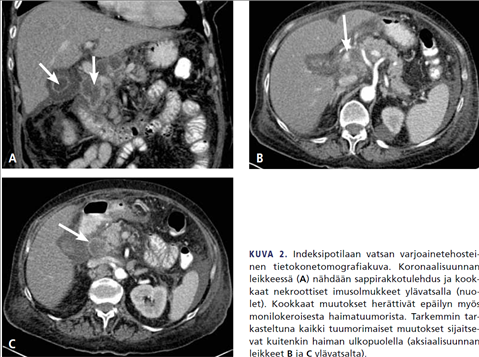 Tuberkuloosi tarttuu sairaalassa ja ruumiinavaussalissa ...