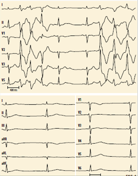 Sydämen lisälyönnit - miten tutkin, miten hoidan?