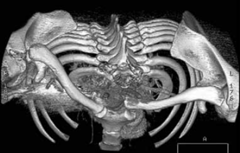Rintalasta-solisluunivelen posteriorinen sijoiltaanmeno