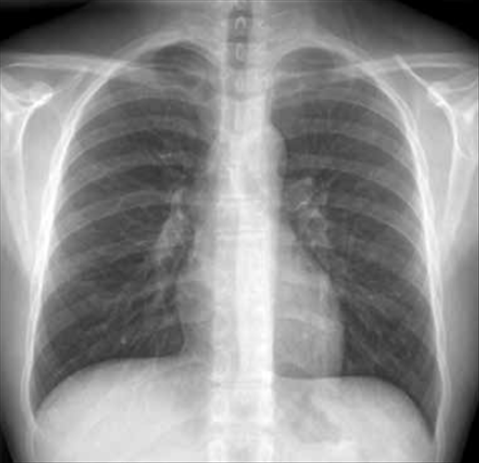 Rintalasta-solisluunivelen posteriorinen sijoiltaanmeno