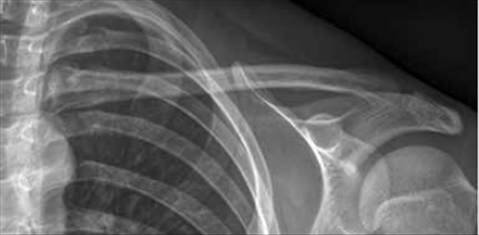 Rintalasta-solisluunivelen posteriorinen sijoiltaanmeno