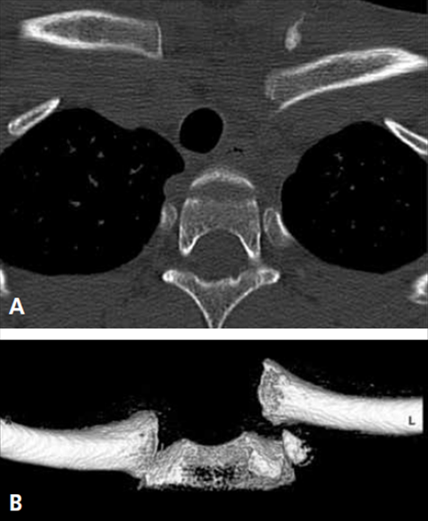 Rintalasta-solisluunivelen posteriorinen sijoiltaanmeno