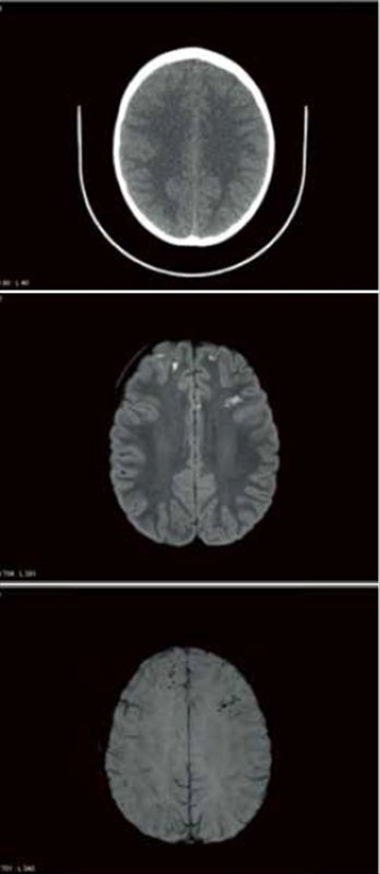 Aivot taklauksen kohteena