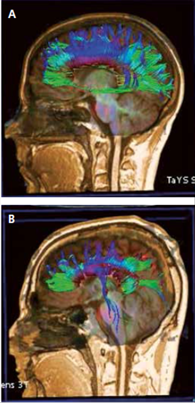 Aivot taklauksen kohteena