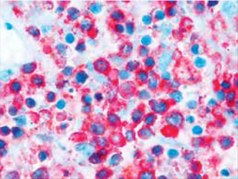 Epäselvä kuumeilu, suurentunut plasman ferritiinipitoisuus ja nopeasti ...