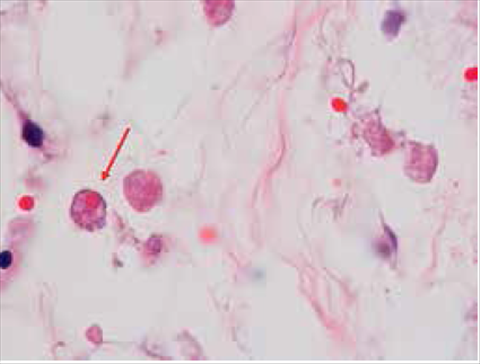 Epäselvä kuumeilu, suurentunut plasman ferritiinipitoisuus ja nopeasti ...