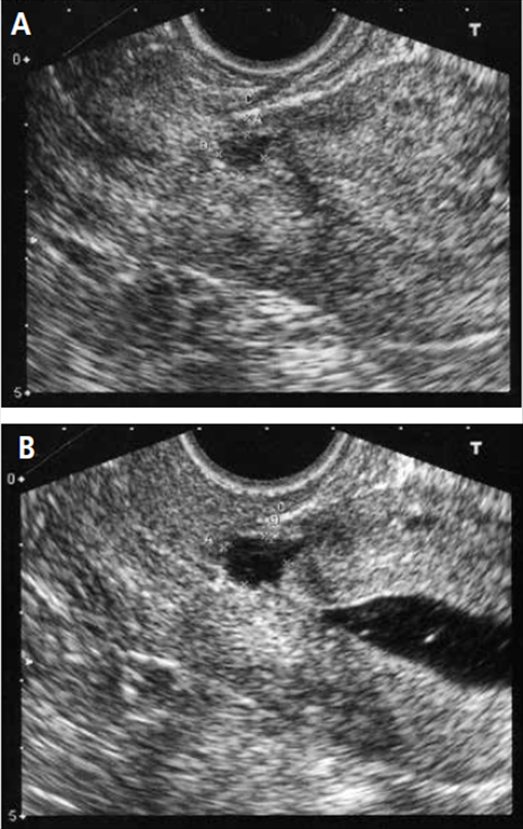 Kohdun keisarileikkausarven pitkäaikaisvaikutukset