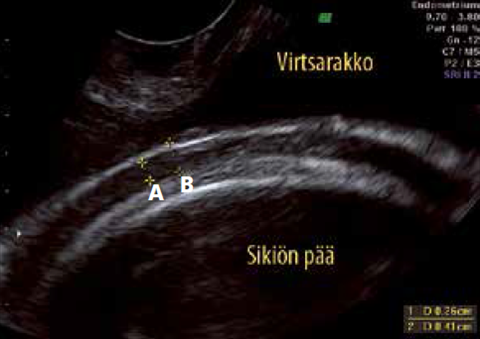 Kohdun keisarileikkausarven pitkäaikaisvaikutukset