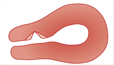 Kohdun keisarileikkausarven pitkäaikaisvaikutukset