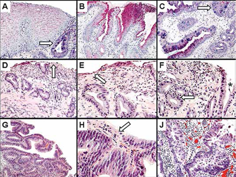 Barrettin ruokatorven radiotaajuusablaatio - voiko ruokatorven ...