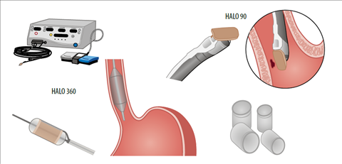 Barrettin ruokatorven radiotaajuusablaatio - voiko ruokatorven ...