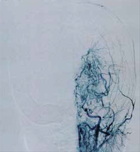 Aivovaltimoiden ohituskirurgia