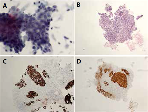 Kaulakyhmy - ohutneulabiopsia diagnostiikassa ja hoidon suunnittelussa