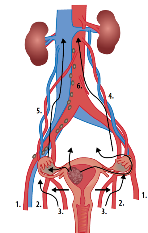 Kohdunrunkosyövän hoito