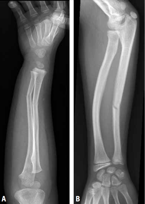 Kasvuikäisten raajamurtumat