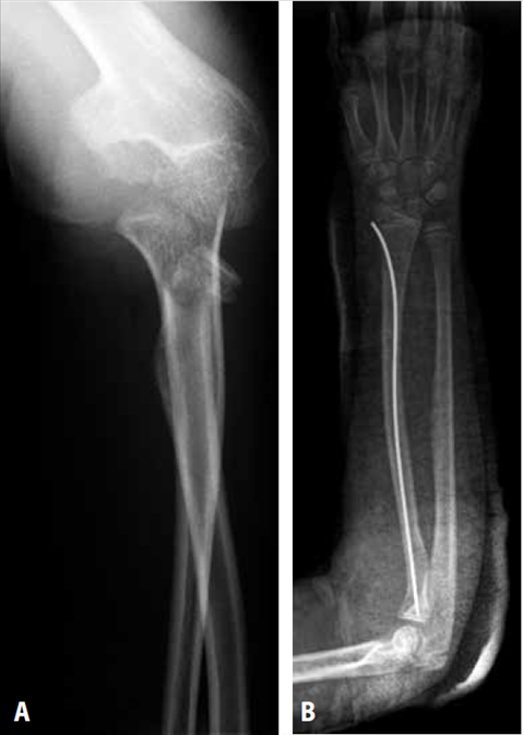 Kasvuikäisten raajamurtumat