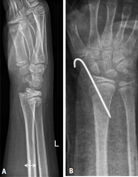 Kasvuikäisten raajamurtumat