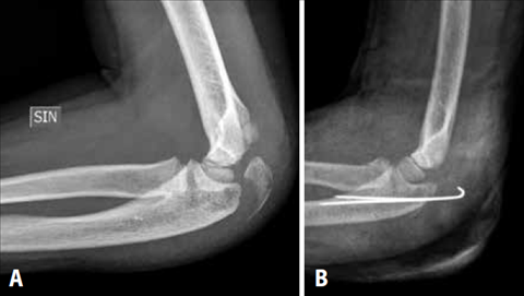 Kasvuikäisten raajamurtumat