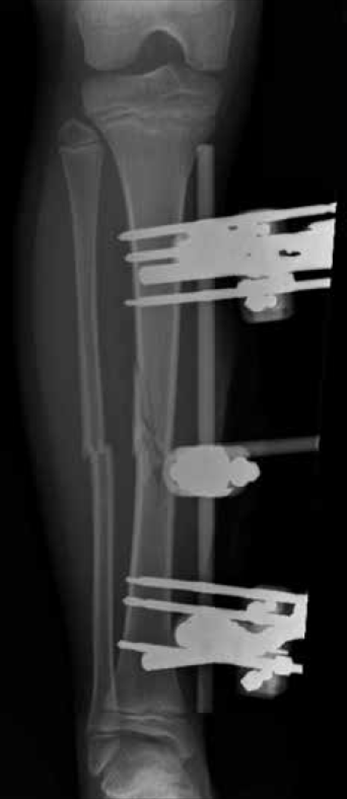 Kasvuikäisten raajamurtumat