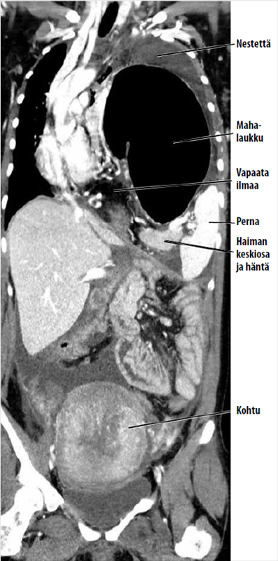 Synnyttäjän pallearuptuura