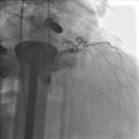 Elvytyksen aikainen sepelvaltimon pallolaajennushoito - mahdollisuus ...