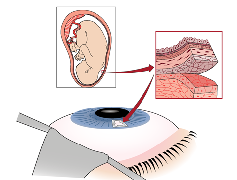 Amnionkalvo silmäsairauksien hoidossa