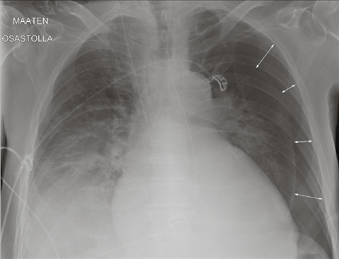 Mihin katosi potilaan sydän?