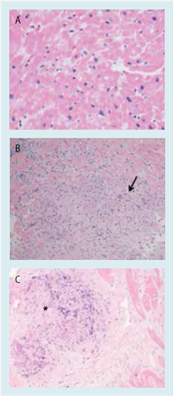 Tulehdukselliset sydänsairaudet - sydänsarkoidoosi ja jättisolumyokardiitti