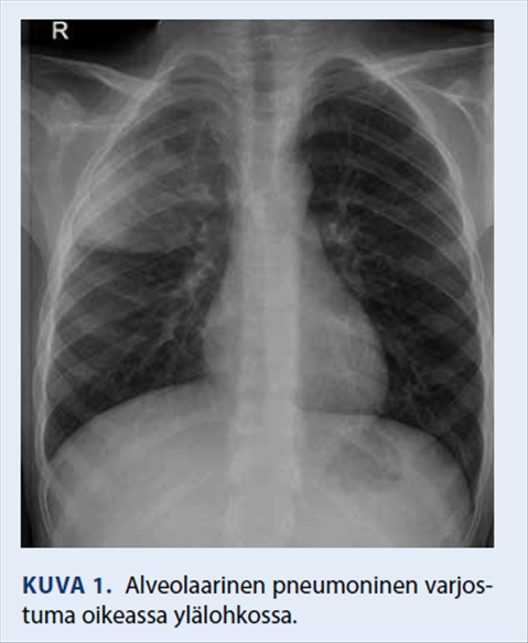Milloin otan lapselta keuhkokuvan?