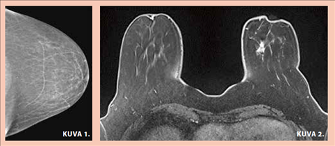 Syöpä ei aina näy mammografiassa