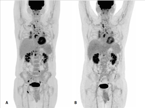 Sarkoidoosi-lymfoomaoireyhtymä