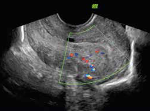 Kohdun adenomyoosi - diagnostinen ja hoidollinen haaste