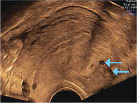 Kohdun adenomyoosi - diagnostinen ja hoidollinen haaste
