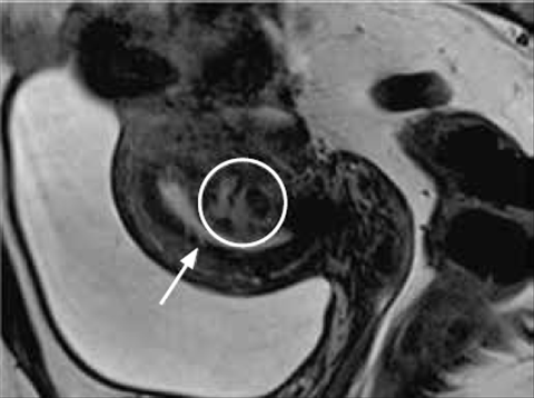 Kohdun adenomyoosi - diagnostinen ja hoidollinen haaste