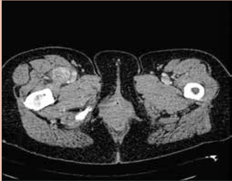 Kun laskimotukos uusii eikä parane