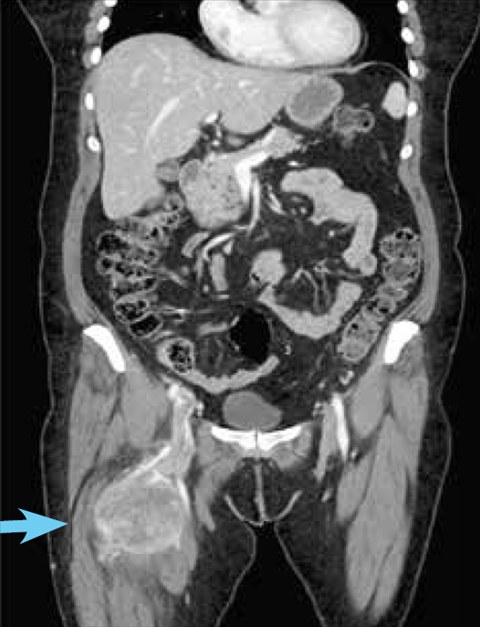 Kun laskimotukos uusii eikä parane