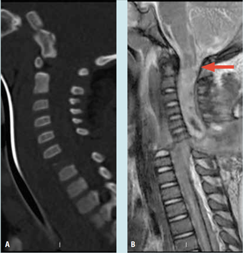 Lastenortopediset kaularankaongelmat