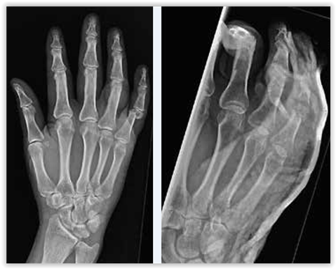 Sormimurtumien konservatiivinen hoito