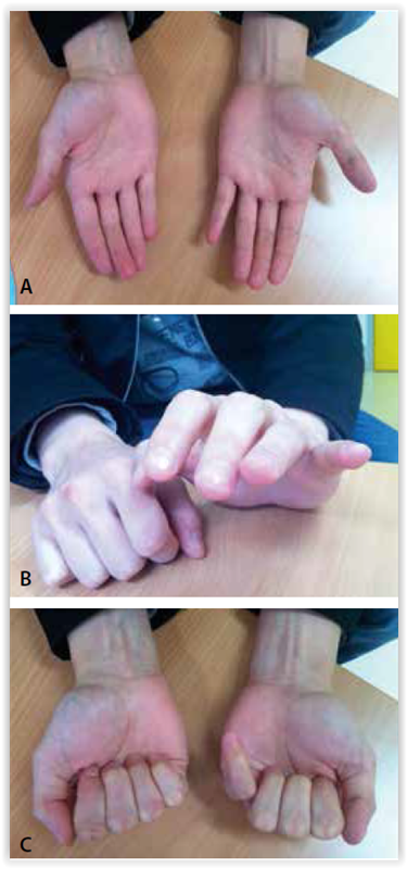 Sormimurtumien konservatiivinen hoito