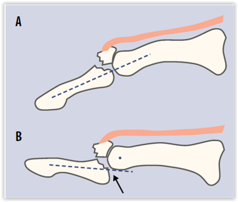 Sormimurtumien konservatiivinen hoito